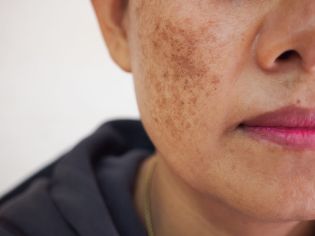 Skin Concerns Pigmentation - The London Skin Clinic